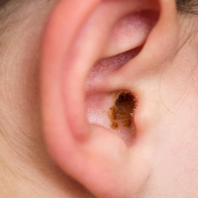 All About Earwax | Decibel Hearing Services | Blog